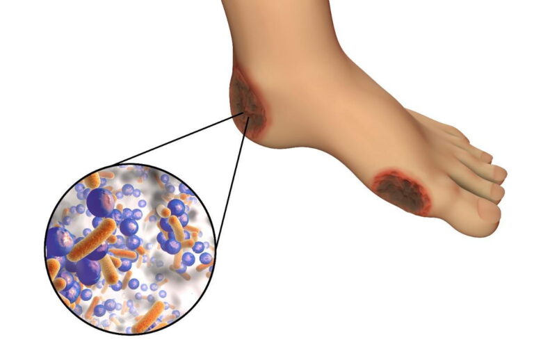 Bacterial-Related Infections of the Foot/Ankle - Southern Maryland Foot ...