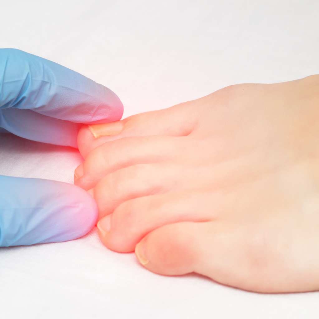 Understanding Toe and Metatarsal Fractures: Causes, Symptoms, and ...
